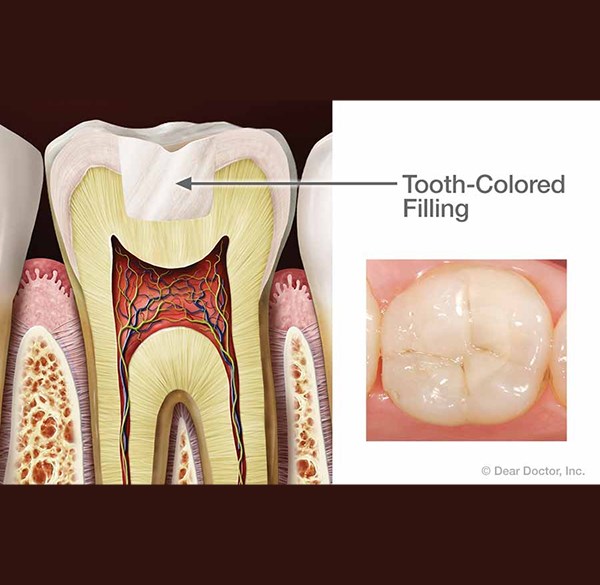 Tooth-Colored Fillings | Seguin Smiles Restorative Dentistry